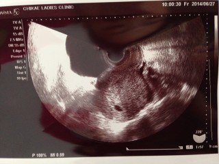 妊娠5週3日(5w3d)の超音波(エコー)写真