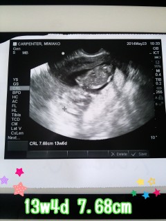 妊娠13w4dのエコー写真(ページ2)