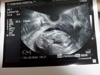 妊娠13w4dのエコー写真(ページ2)