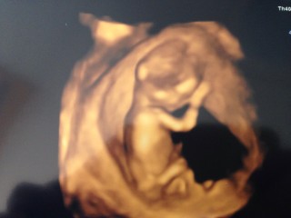 妊娠13週4日(13w4d)の超音波(エコー)写真