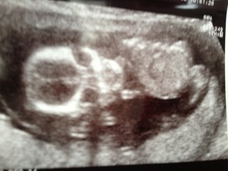 妊娠14週5日(14w5d)の超音波(エコー)写真