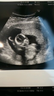 妊娠14週5日(14w5d)の超音波(エコー)写真