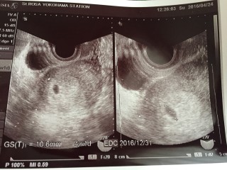 妊娠5週3日(5w3d)の超音波(エコー)写真