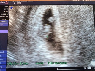 妊娠6w5dのエコー写真(ページ2)