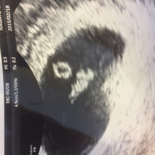 妊娠6w5dのエコー写真(ページ3)