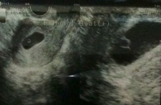 妊娠6w5dのエコー写真(ページ3)