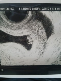 妊娠6w5dのエコー写真(ページ3)