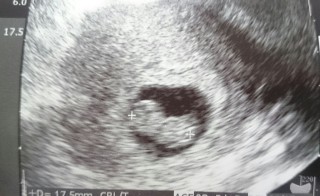 妊娠8w5dのエコー写真(ページ3)