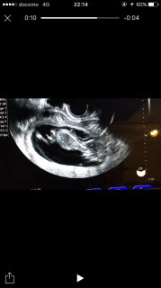 妊娠13週4日(13w4d)の超音波(エコー)写真