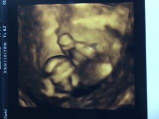 妊娠13週4日(13w4d)の超音波(エコー)写真