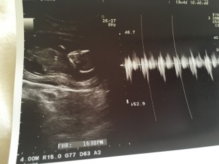 妊娠13週4日(13w4d)の超音波(エコー)写真