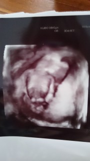 妊娠14週5日(14w5d)の超音波(エコー)写真