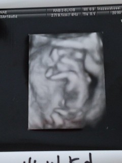 妊娠14週5日(14w5d)の超音波(エコー)写真