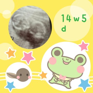 妊娠14週5日(14w5d)の超音波(エコー)写真