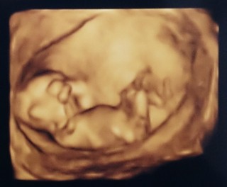 妊娠14週5日(14w5d)の超音波(エコー)写真