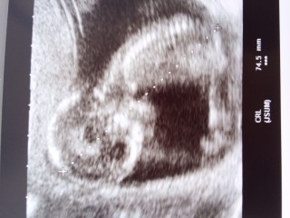 妊娠14週5日(14w5d)の超音波(エコー)写真