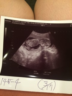 妊娠14週5日(14w5d)の超音波(エコー)写真