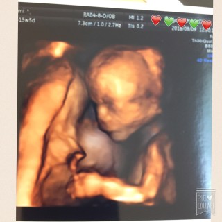 妊娠14週5日(14w5d)の超音波(エコー)写真