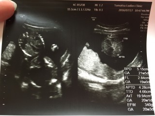 妊娠19週4日(19w4d)の超音波(エコー)写真