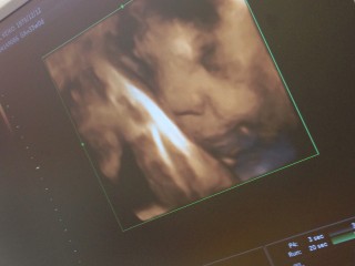 妊娠33週0日(33w0d)の超音波(エコー)写真