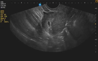 妊娠5週3日(5w3d)の超音波(エコー)写真