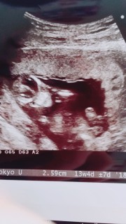 妊娠13週4日(13w4d)の超音波(エコー)写真