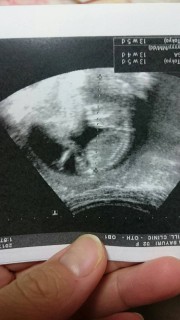 妊娠13週4日(13w4d)の超音波(エコー)写真