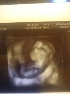 妊娠14週5日(14w5d)の超音波(エコー)写真