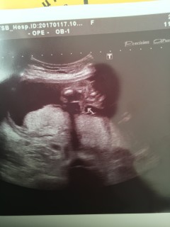 妊娠19週4日(19w4d)の超音波(エコー)写真
