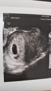 妊娠5週3日(5w3d)の超音波(エコー)写真