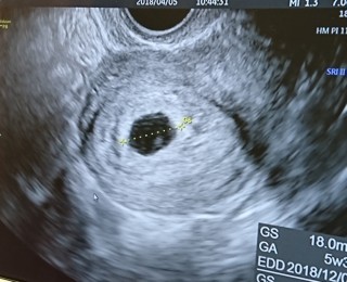 妊娠5週3日(5w3d)の超音波(エコー)写真