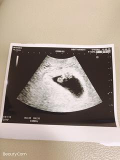 妊娠7週4日(7w4d)の超音波(エコー)写真