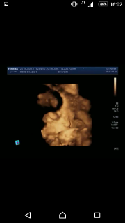 妊娠33週0日(33w0d)の超音波(エコー)写真